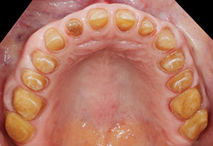 Trends in All-Ceramic Material Options – Dentistry Today