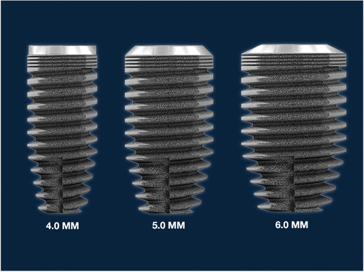 Implant Prevents Bone Loss and Improves Soft-Tissue Preservation ...