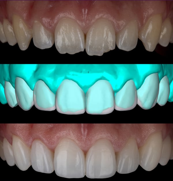SmileFast – A Revolution in Direct Paste Resin Composite Veneers ...